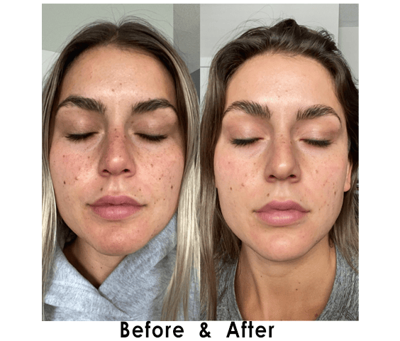 IPL Photofacial: Understanding Its Benefits and Effectiveness